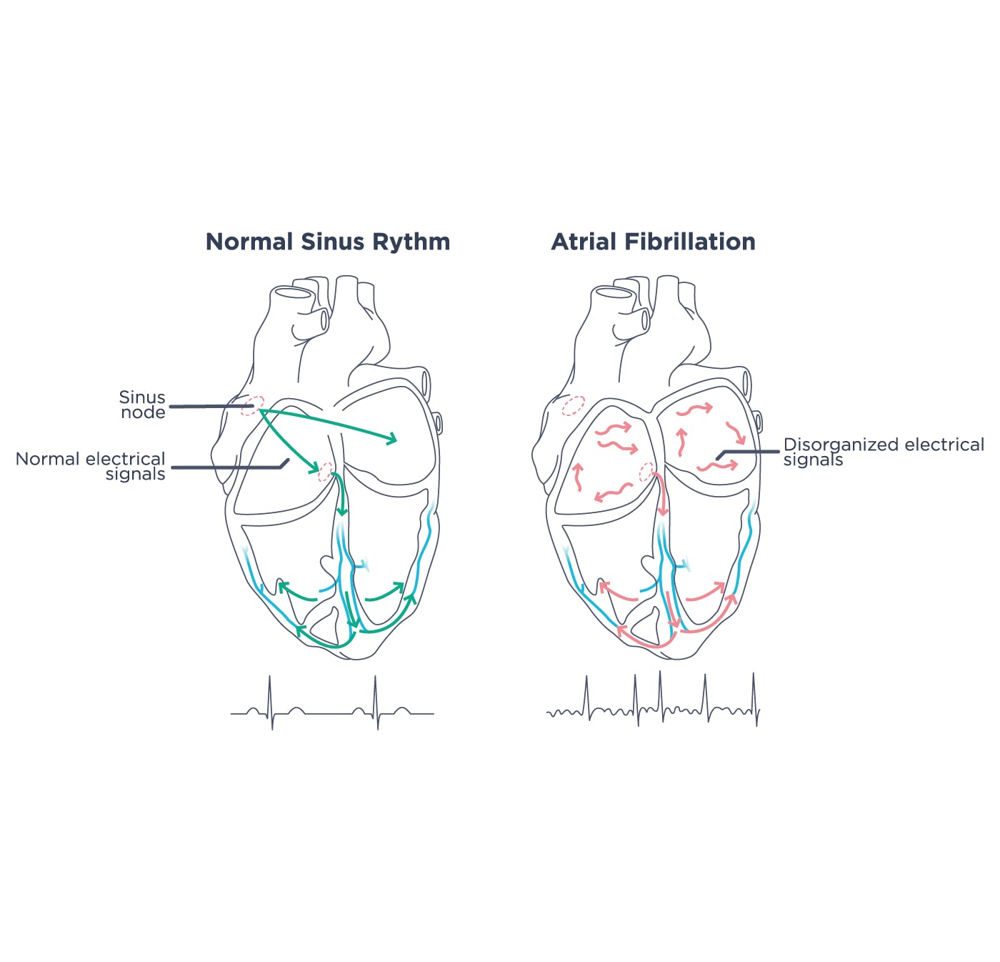 AFib: Atrial fibrillation symptoms and diagnosis | Withings